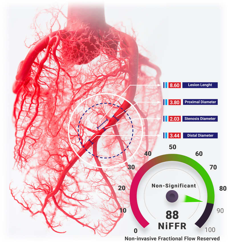 Non-Invasive Fractional Flow Reserve ( NiFFR ) | Mobtakeran Salamat Fakher